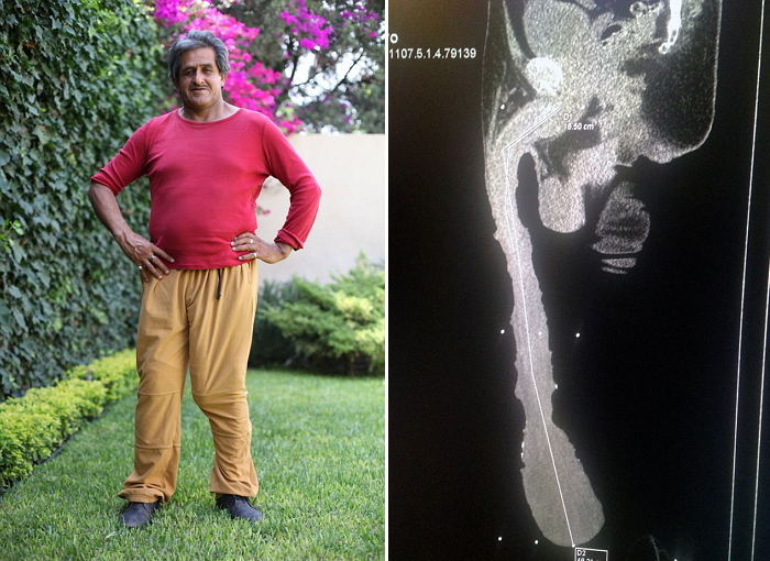 성기 축소 수술 거부한 세계서 가장 긴 음경 가진 남성.jpg : MLBPARK