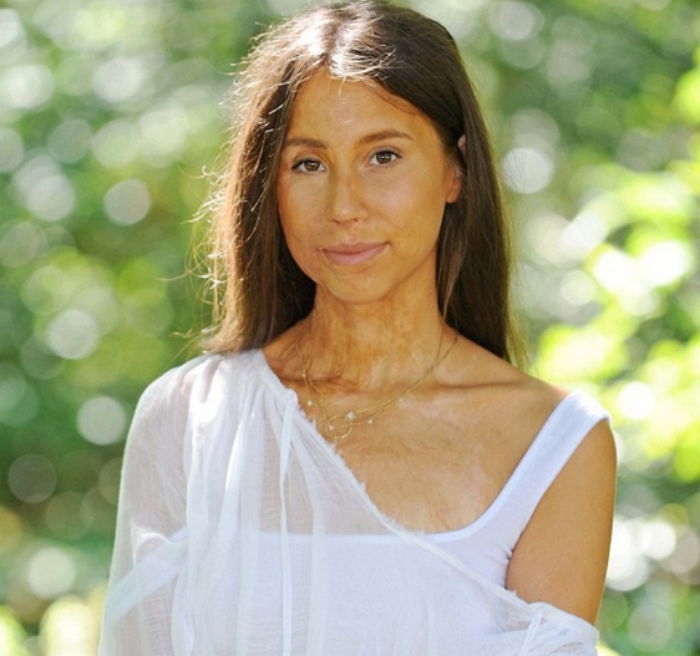 묻지마 염산테러 당한 여성이 ‘70번 수술’ 후 되찾은 놀라운 모습 - 인사이트