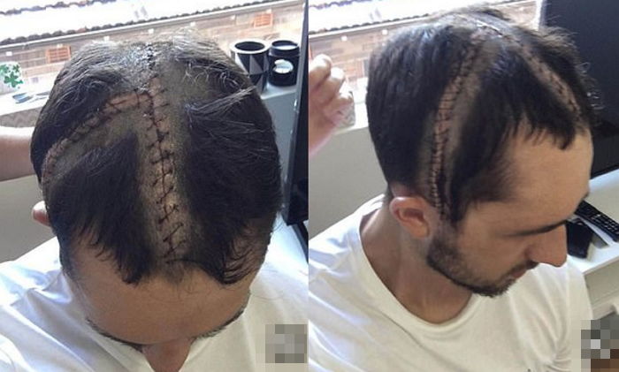 “머리 한쪽이 ‘움푹’ 뭉개졌는데 폭행범들은 집행유예로 풀려났습니다” - 인사이트